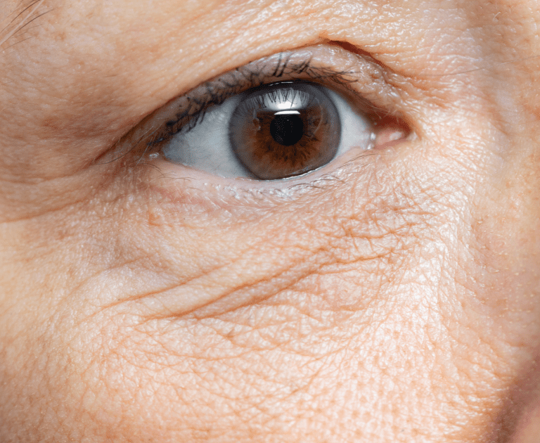 EYELID LIFT AND TREATMENT OF EYE WRINKLES – Dermalaserzentrum